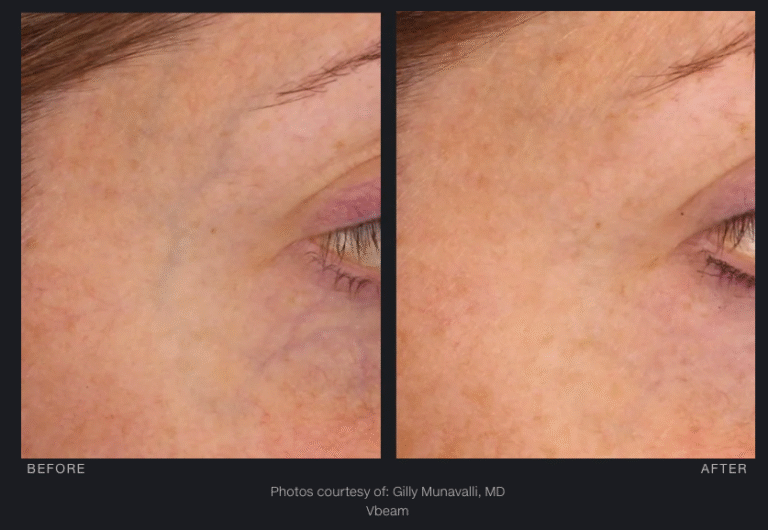 Vbeam Laser - Center for Aesthetic Medicine